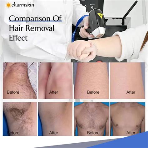 How To Do A Laser Hair Removal Treatment