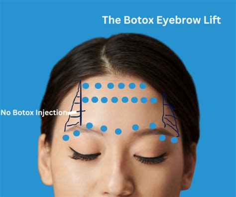 The Botox Eyebrow Lift Everything You Need To Know