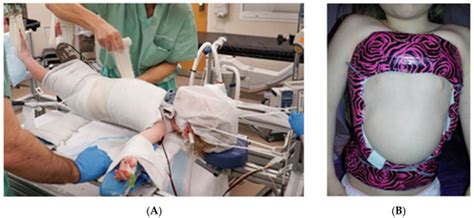 Clinical Observations And Treatment Approaches For Scoliosis In Prader