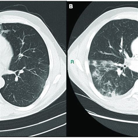 A Bilateral Ground Glass Opacities With Crazy Paving Aspects And More
