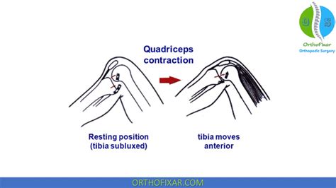 Quadriceps Active Test Explained Easily Orthofixar