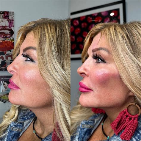 Pdo Barbs Designer The Botox Bar And Aesthetics Dallas