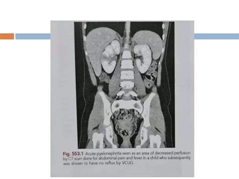 Case Presentation Of Pyelonephritis Pptx