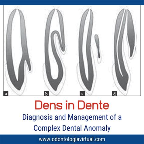 Dens In Dente Diagnosis And Management Of A Complex Dental Anomaly