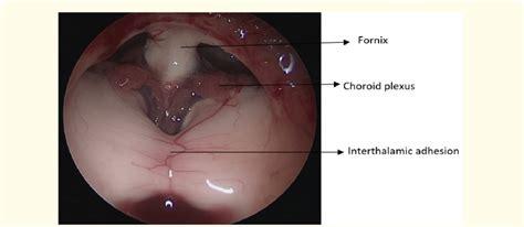 Interthalamic Adhesion