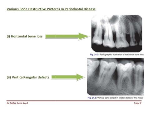 024bone Loss And Patterns Of Bone Destruction