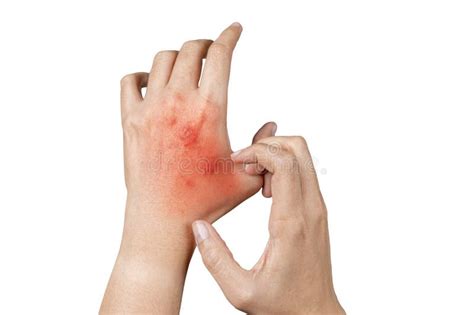 Psoriasis Skin Rash And Scaling On The Patient S Skin The Concept Of