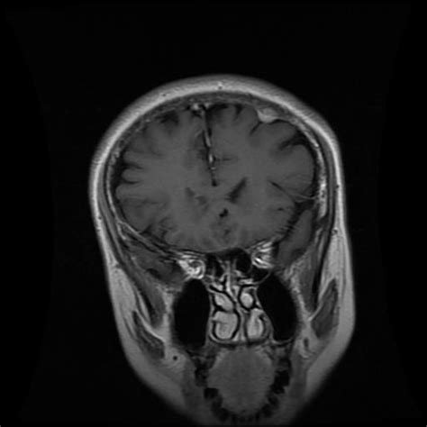 Mri Image Classification Classification Model By Ai Werkstuk Weor