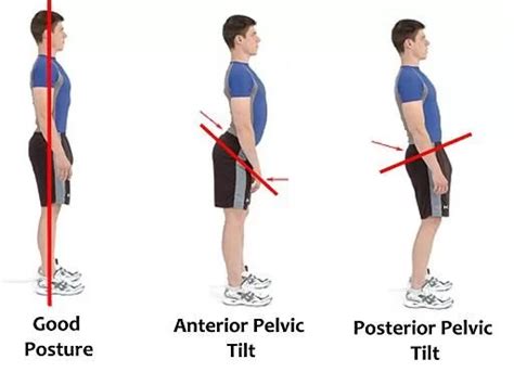 How To Fix Posterior Pelvic Tilt Exercises And Stretches For Relief