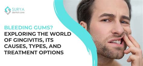 Gingivitis Archives Surya Dental Care