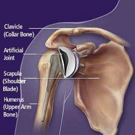 An Example Of A Schematic Of An Artificial Shoulder Joint Download Scientific Diagram