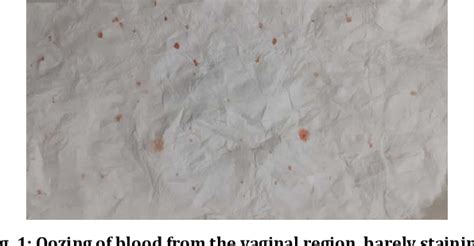 Figure 1 From Hematohidrosis A Rare Bleeding Phenomenon Semantic Scholar