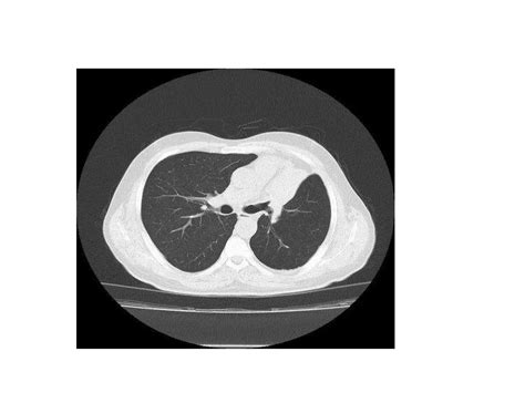 Lobar Collapse Xray Pptx