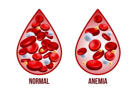Iron Deficiency Anemia Symptoms