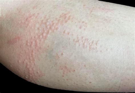 Maculopapular Rash Diagnosis And Disease Information