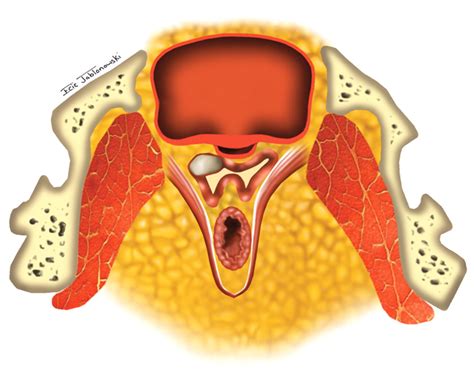 Pre And Postoperative Evaluation Of Urethral Diverticulum Ajr