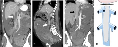 Partial Inferior Vena Cava Reconstruction With Cryopreserved Aortic