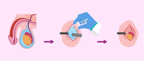 What Is A Hydrocele Symptoms Causes And Treatment