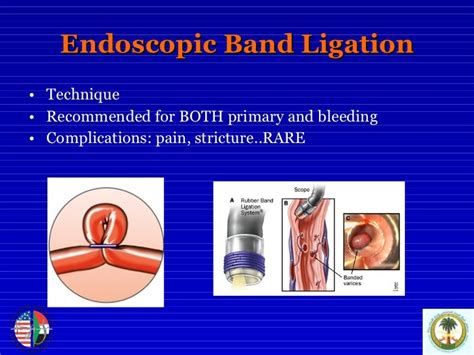 Rubber Band Ligation In Esophageal Varices At Russell Romine Blog