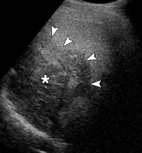 Sparing Of Fatty Infiltration Around Focal Hepatic Lesions In Patients