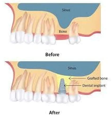 Sinus Lift In Londons No 1 Clinic Dulwich Dental Office