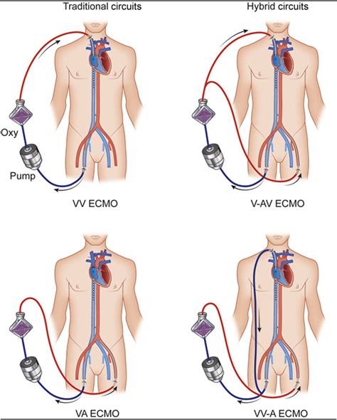 The Role Of Ecmo Support In Airway Procedures Bja Education