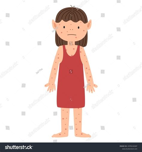 Maculopapular Rash Over 20 Royalty Free Licensable Stock Illustrations