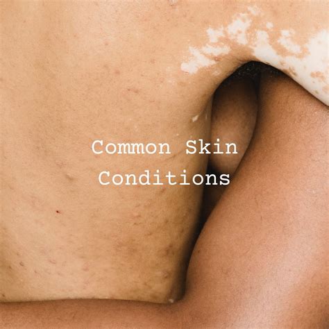 Navigating Common Skin Conditions From Acne To Vitiligo Dr Kally Papantoniou