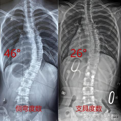 女孩脊柱侧弯治疗两个月后，剃刀背减少10°，体态畸形改善！ 知乎