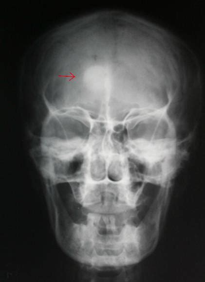 Benign Bone Tumors Osteoid Osteoma Giant Cell Radiology