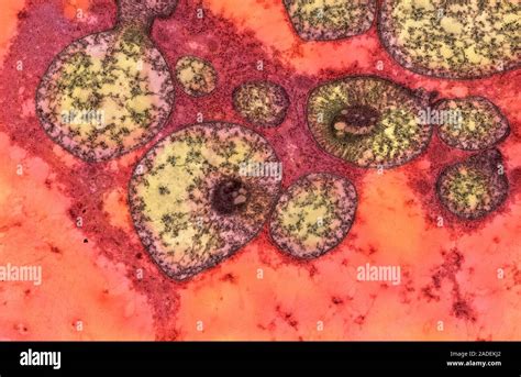 Abnormal Mitochondria In Acidemia Coloured Transmission Electron Micrograph Tem Of A Section