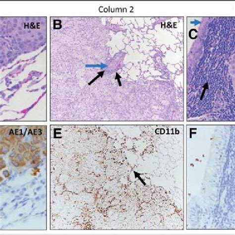 Group 1 Hande And Ihc Staining Column 1 Hande Staining Of Adenocarcinoma