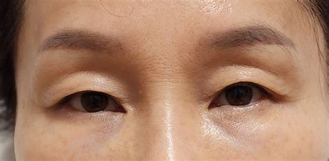 상안검 눈매교정 후기 리얼후기 눈이 예쁘다그래서 아몬드성형외과