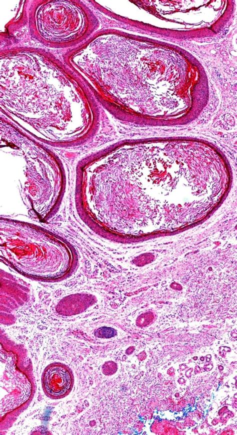 Pathology Of Trichoadenoma Pathology Art Reference Microscopic