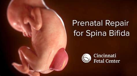 Spina Bifida Medical Animation Cincinnati Fetal Center Youtube