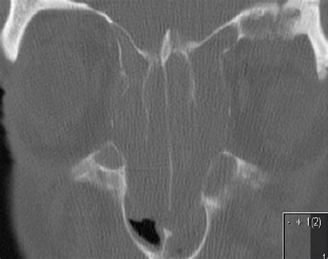 A Coronal Ct Showing Widespread Bilateral Opacification With Expansion