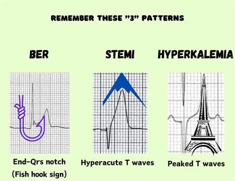 Knowledge 🔰 Remember These “3” Patterns 😬🔰 Ecg Ekg