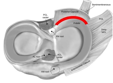 Posterior Medial Meniscus Root Tears Clinical Implications Surgical