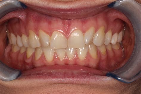 Aligner Treatment Clinical Cases Acura Aligner Solutions