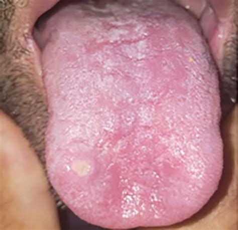 Oral A And Genital B Aphthosis Download Scientific Diagram