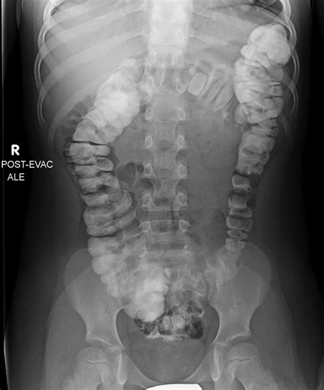 Constipation Radiating Hope