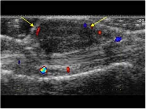 Musculoskeletal Joints And Tendons 6 4 Fingers Case 6 4 3 Arthritis