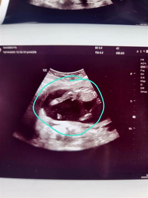 16 Week Ultrasound Everyone Says Girl But Nipt And Ultrasound Tech Said