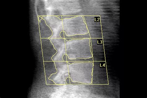 Horizon® Dxa System Bone And Body Composition Hologic® Uk