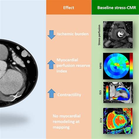 Effects Of Coronary Sinus Reducer Device On The Myocardium Of Patients