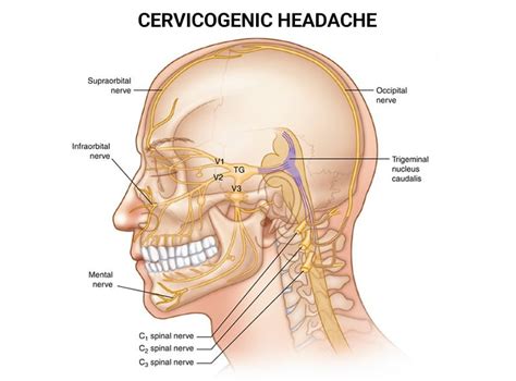 All You Need To Know About Cervicogenic Headache Advanced Headache Center