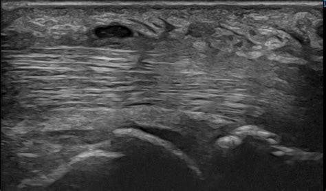 Tendovaginitis Stenosans Flexor Tendons Sonotool®