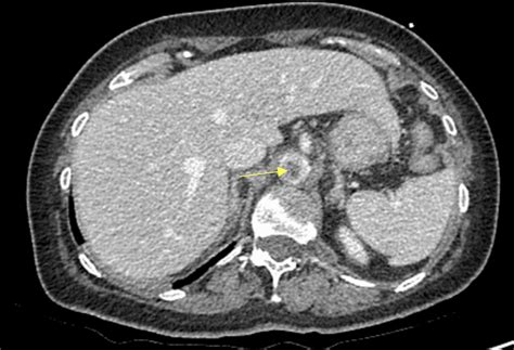 Role Of Pocus In Assessing An Acute Aortic Thrombus Pocus Journal