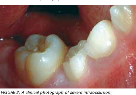 Figure 3 From Management Of Primary Molar Infraocclusion In General