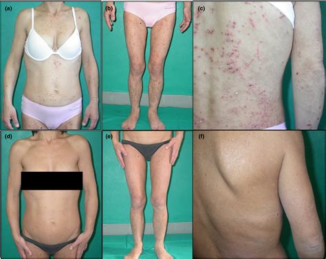 Elastosis Perforans Serpiginosa